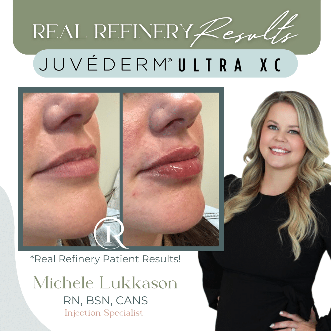 5 Ways JUVÉDERM® Can Enhance Your Lips - Burnsville MN & Lakeville MN