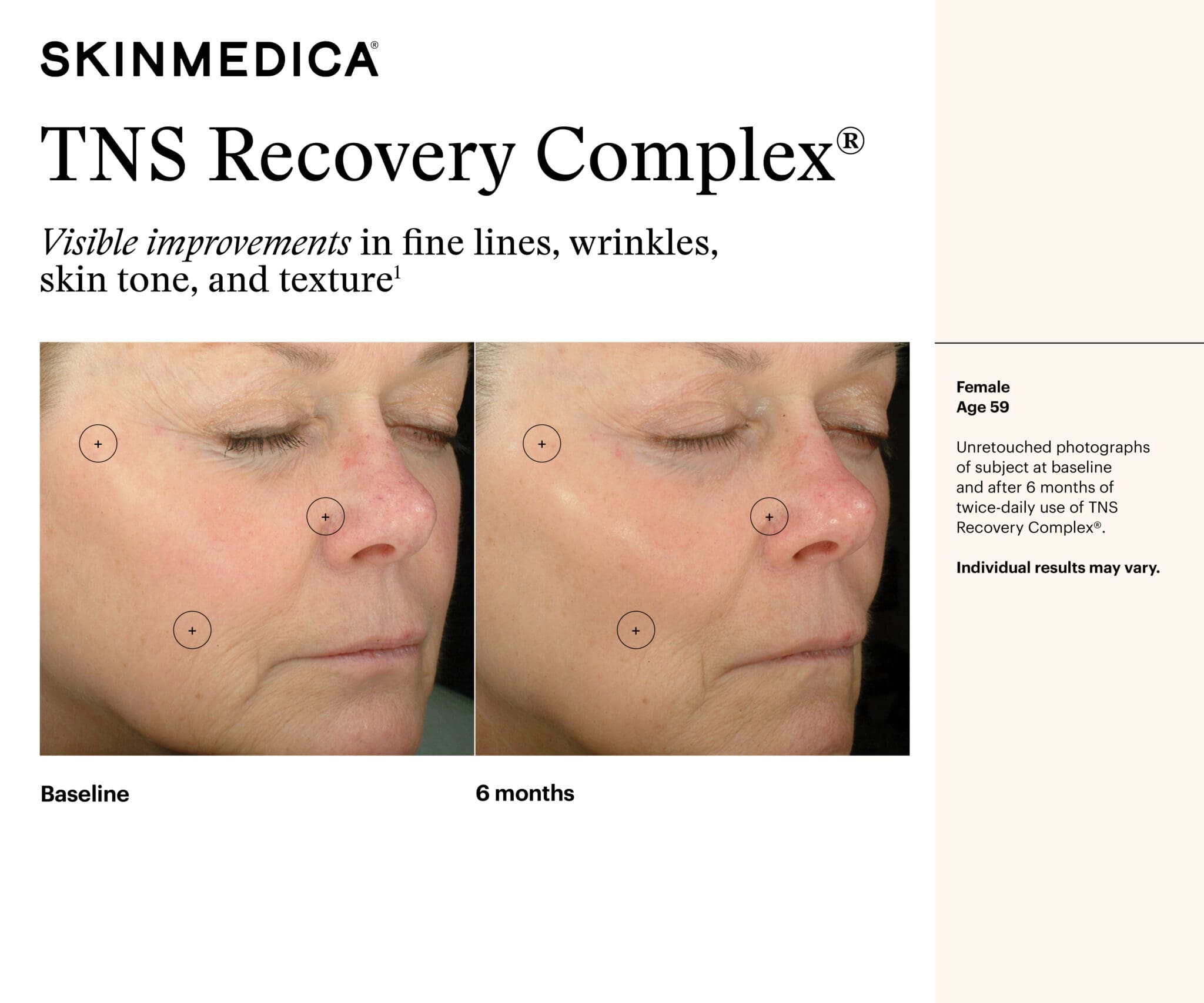 Loose Skin After Weight Loss? 6 Non-Surgical Solutions That Improve ...